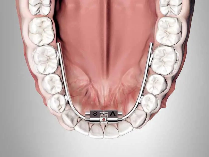 Tornillo expansor dental | Bulonera Da Silva